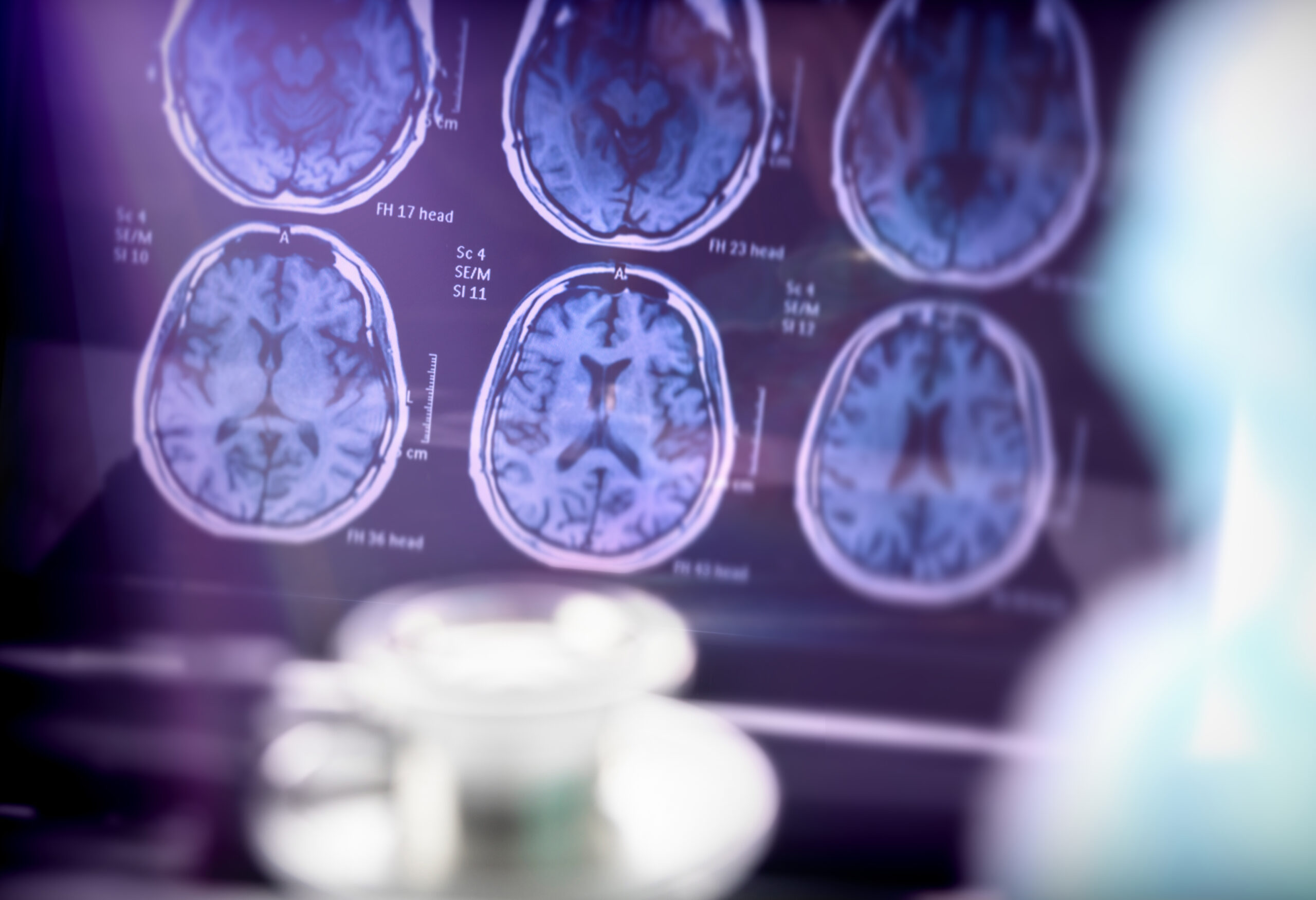 TGA doubles down on rejection of Alzheimer’s drug – Aged Care Insite